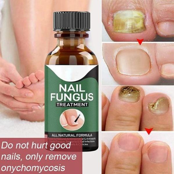 7 Days Fungal Nail Treatment Serum Foot Nail Fungus Removal Repair Gel ...